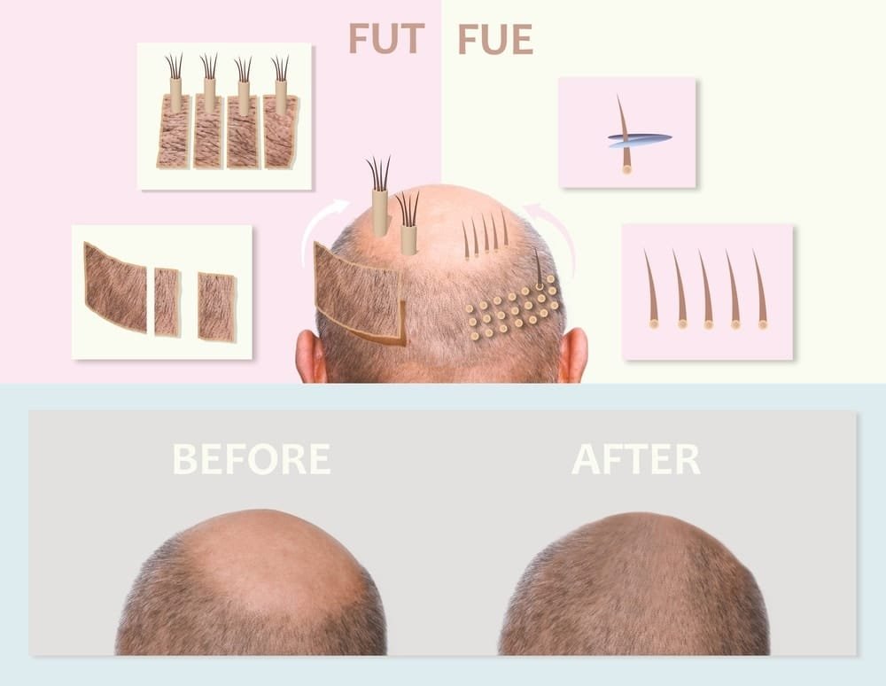 Hair Transplantation With Fue Technique – Elysian